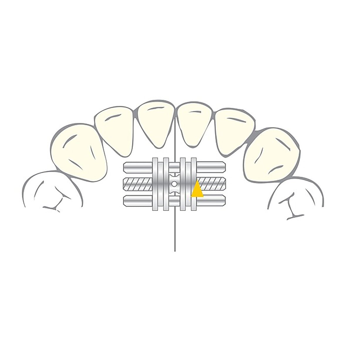 Vector 100 Mini - Vérin Orthodontique - Scheu Dental - 10 U