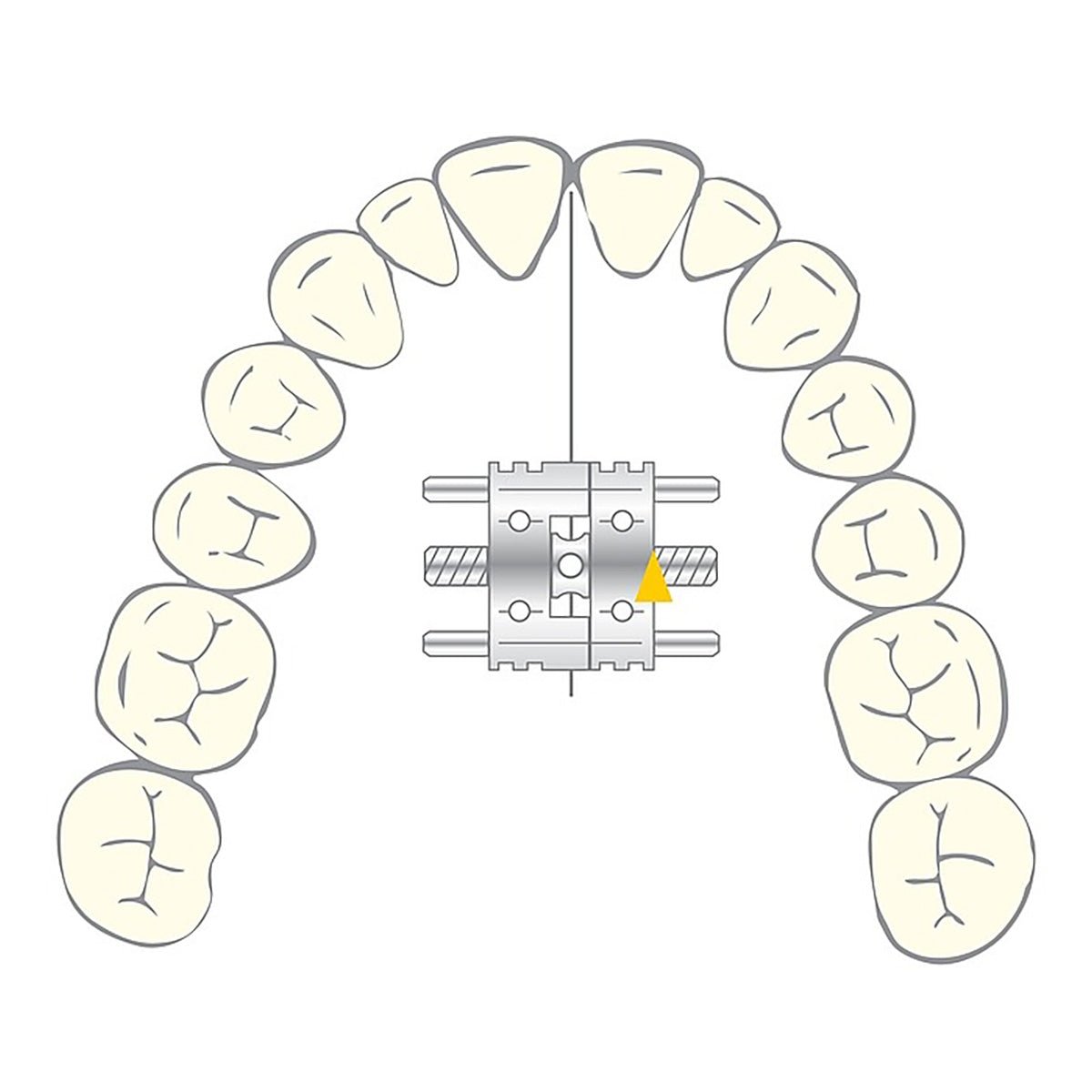Vector 200 Mini Vérin Orthodontique - Scheu Dental - 10 U